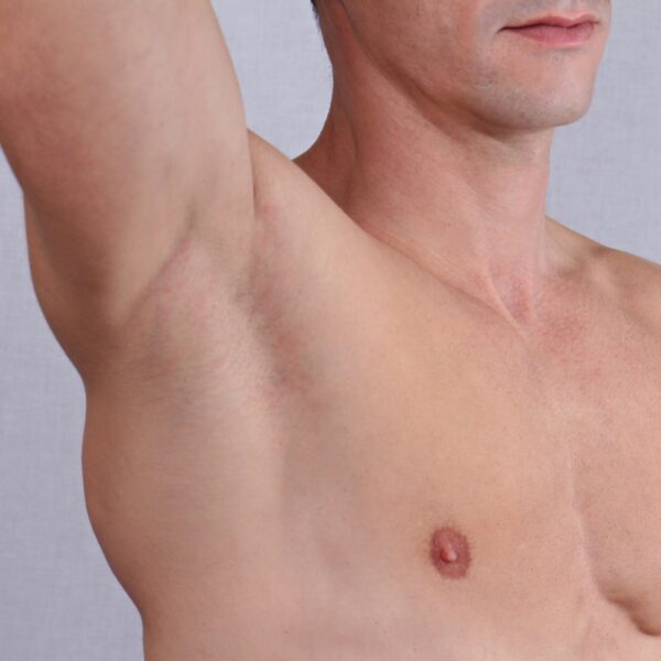 Mastectomia masculina – Clínica Cince